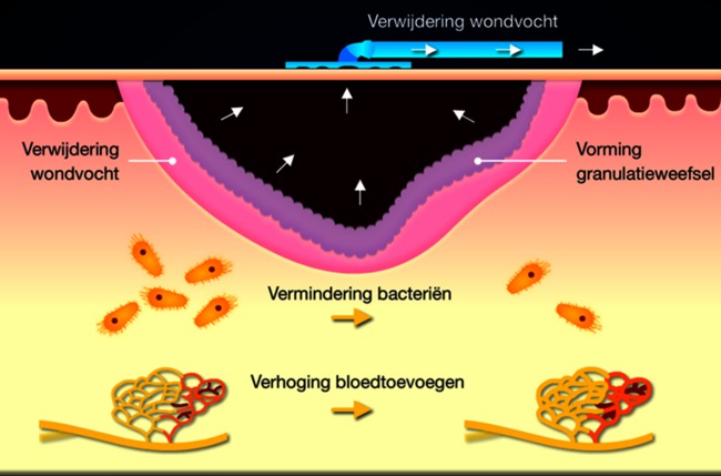VAC Pomp - Euser Care - Altijd Dichtbij VAC Pomp